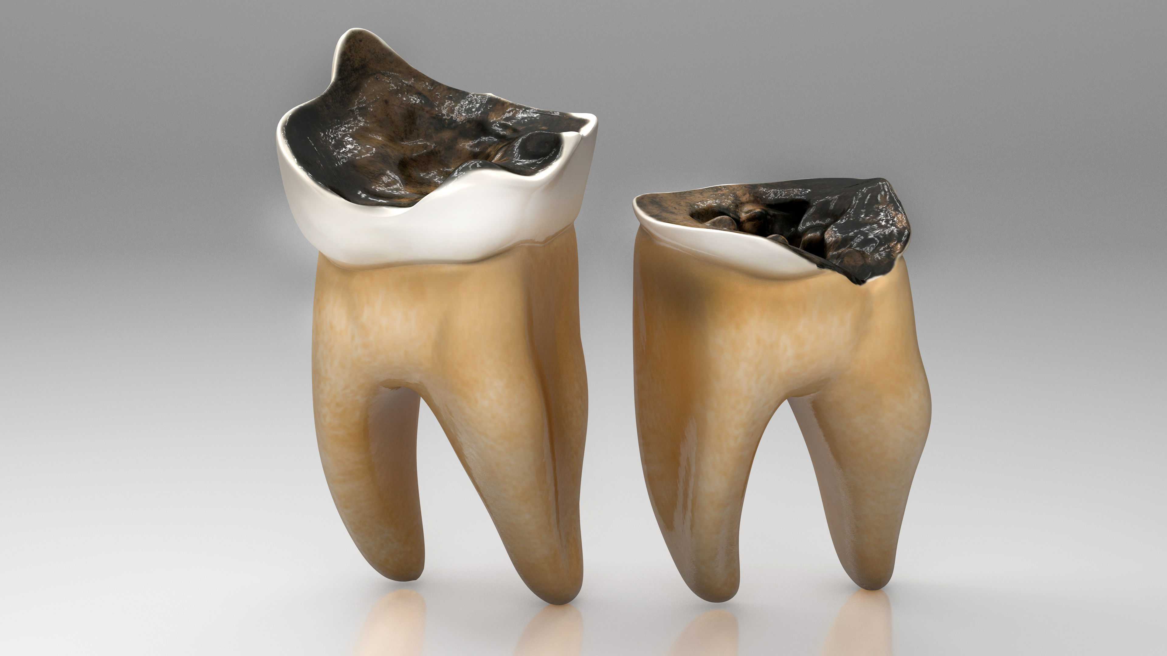 3D model Human Tooth Decay A 3D Dental Caries Progression Model VR / AR ...