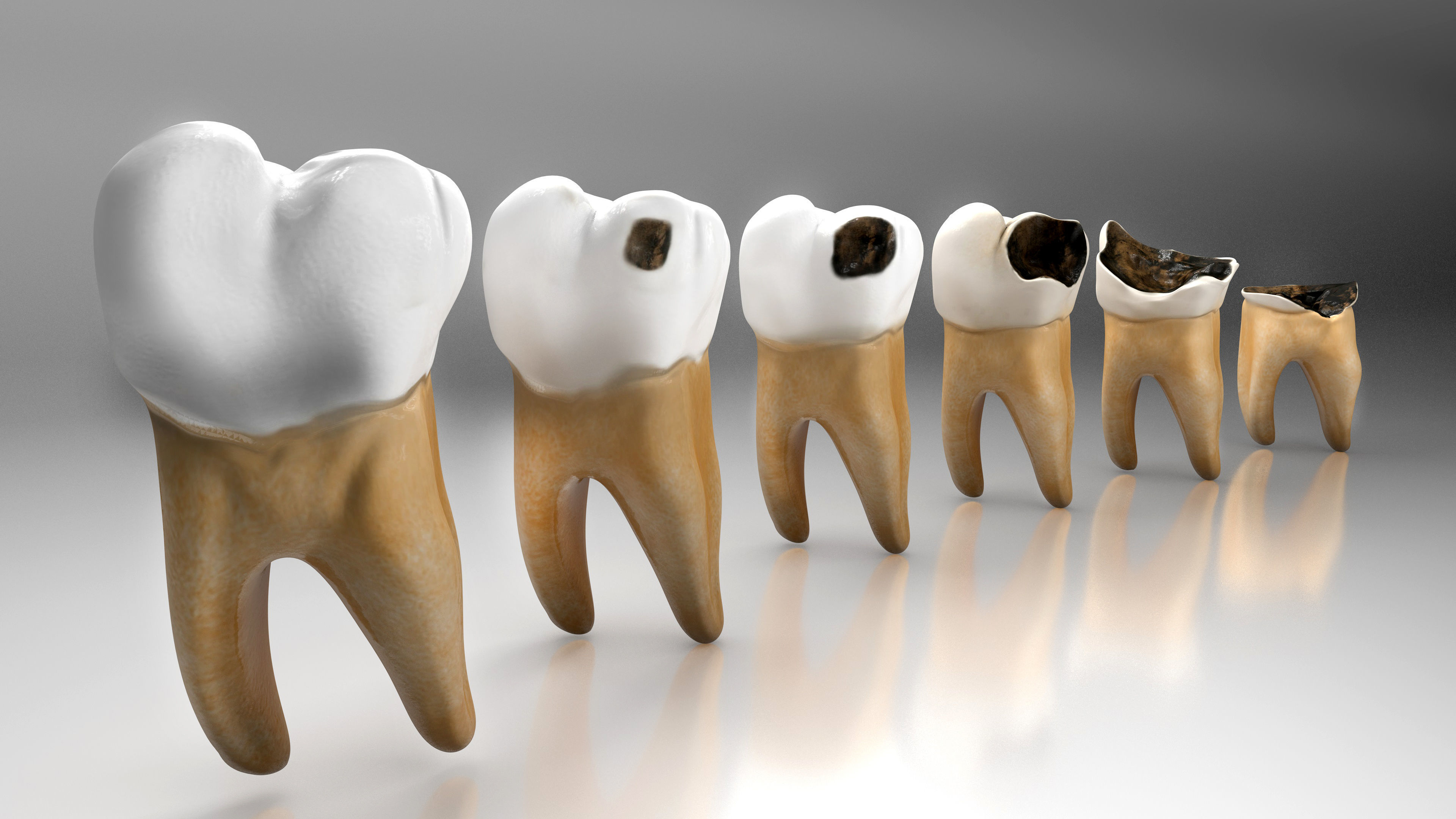 3D model Human Tooth Decay A 3D Dental Caries Progression Model VR / AR ...