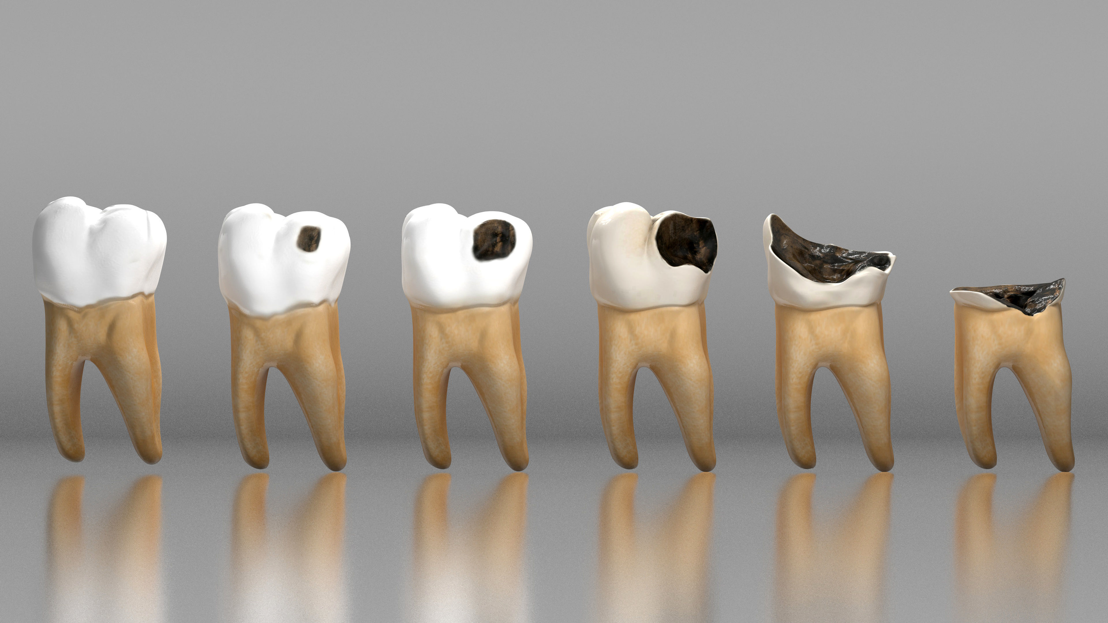 3D model Human Tooth Decay A 3D Dental Caries Progression Model VR / AR ...