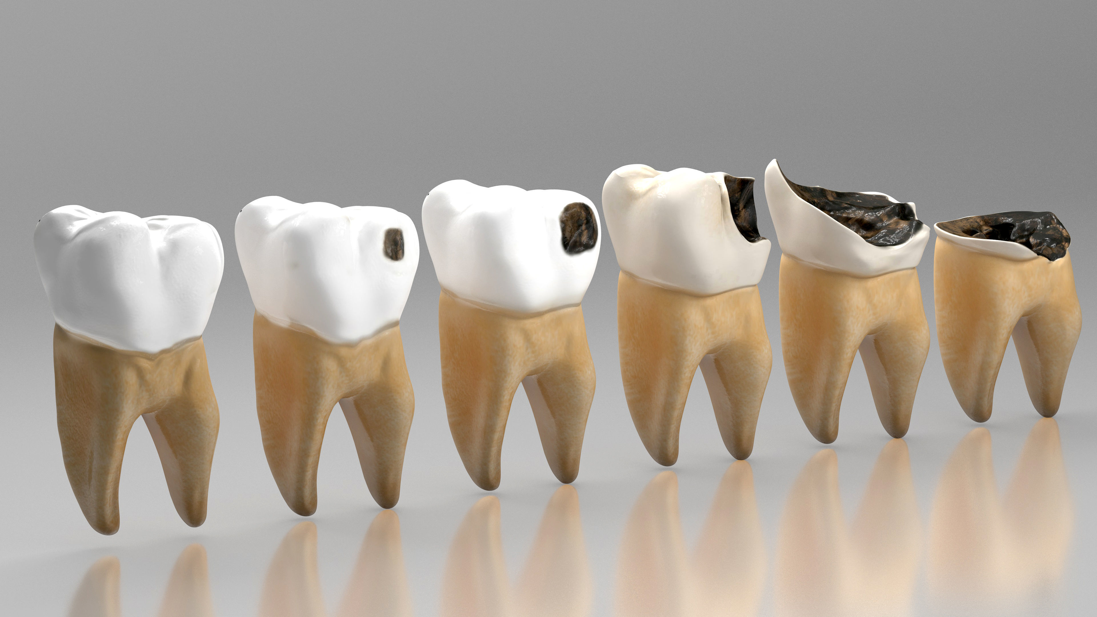 3D model Human Tooth Decay A 3D Dental Caries Progression Model VR / AR ...