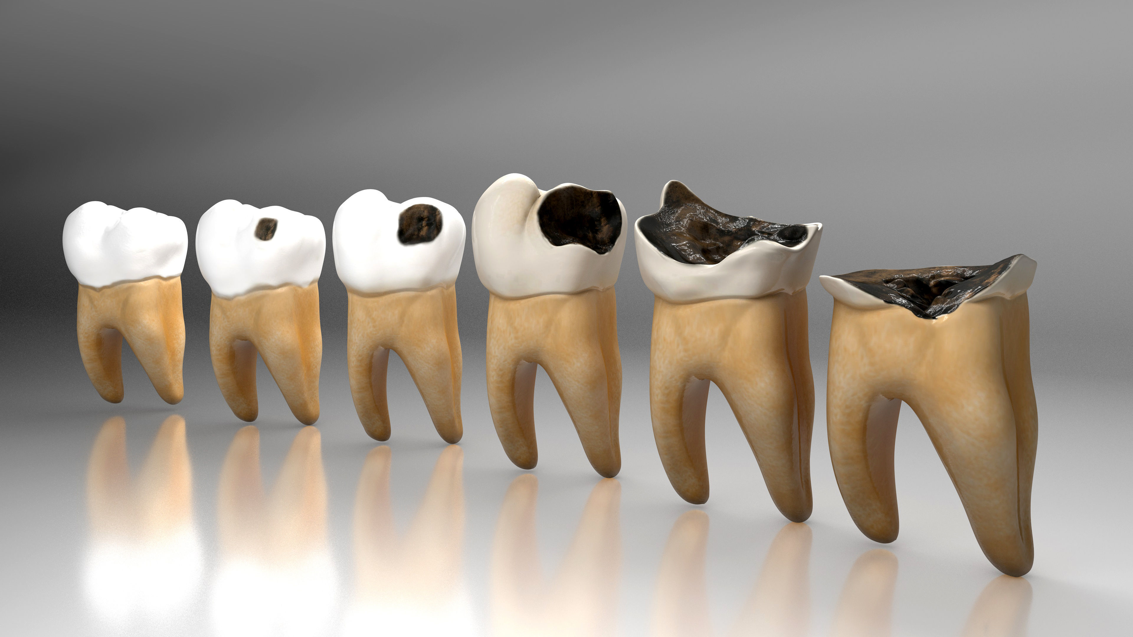 3D model Human Tooth Decay A 3D Dental Caries Progression Model VR / AR ...