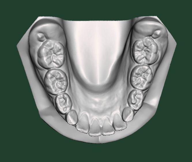 D013 Pediatric dental model from IOS 3D model 3D printable | CGTrader