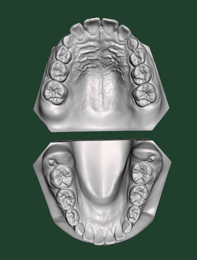 D013 Pediatric dental model from IOS 3D model 3D printable | CGTrader