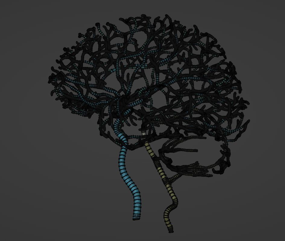 3D Model of Brain and Aneurysm 3D model | CGTrader