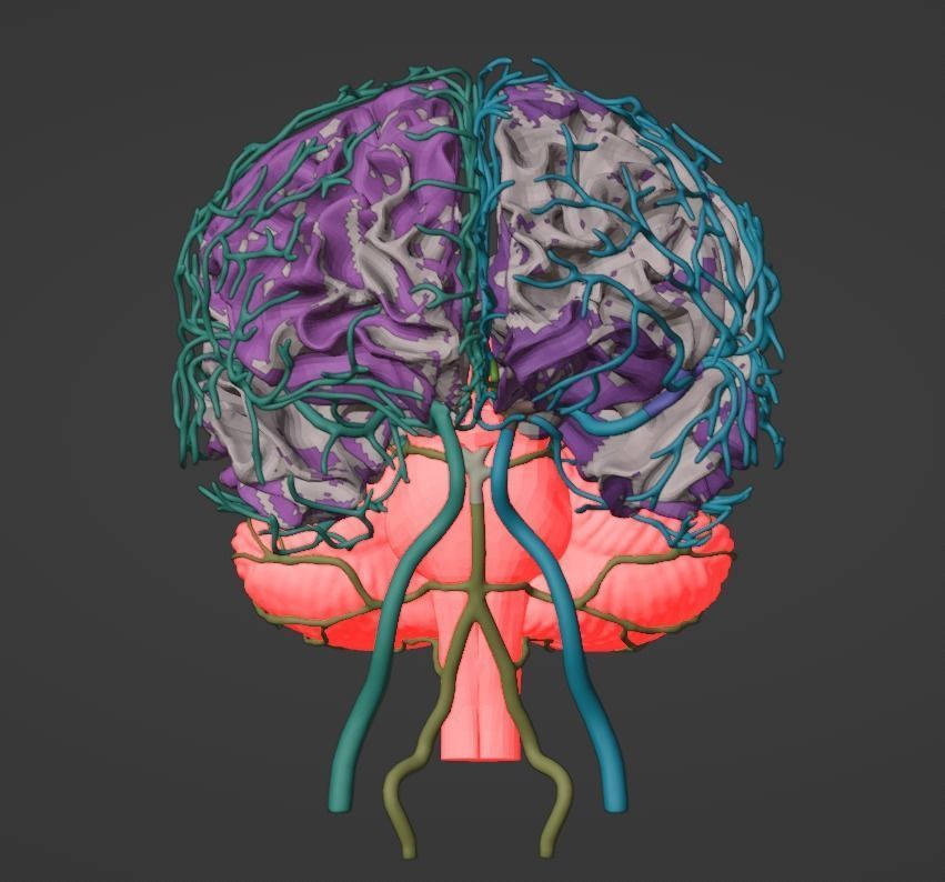 3D Model of Brain and Aneurysm 3D model | CGTrader