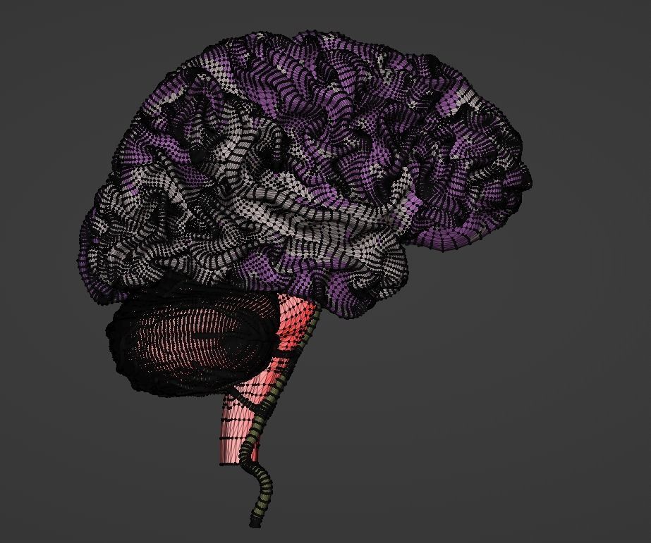 3D Model of Brain and Aneurysm 3D model | CGTrader