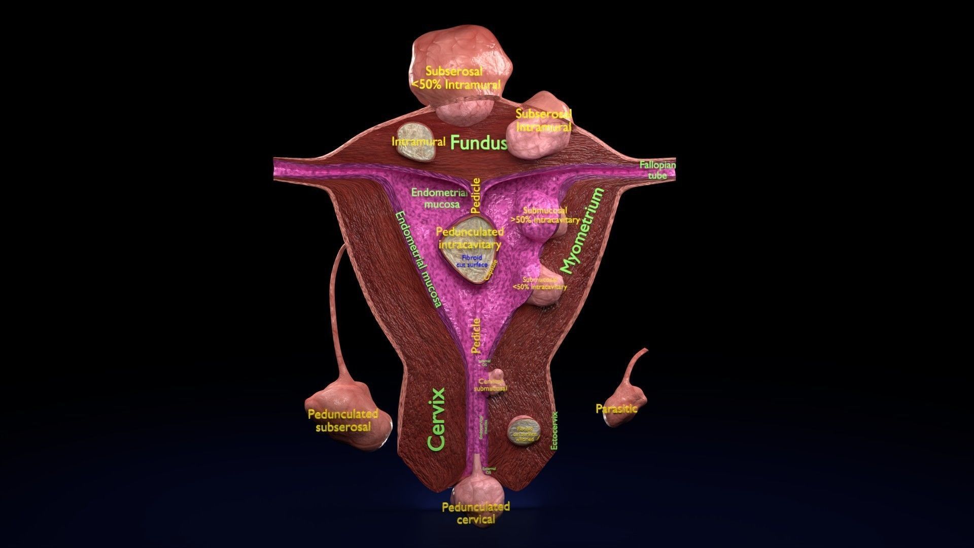 3D model Fibroid Uterus Human female 3D VR / AR / low-poly | CGTrader