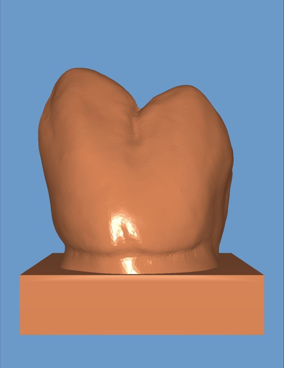 Class ii Amalgam cavity preparation on upper molar 3D model 3D ...