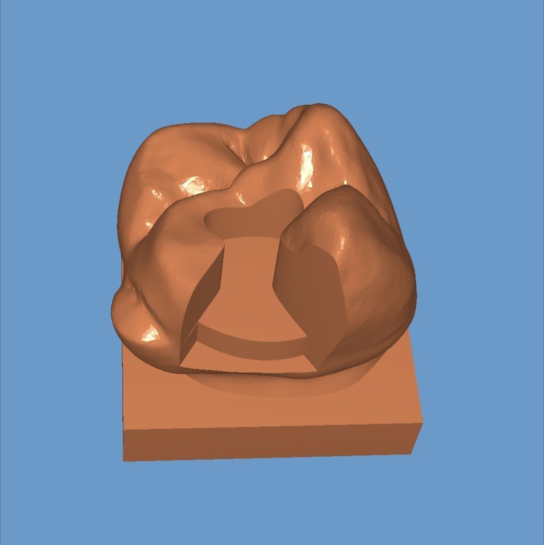 Class ii Amalgam cavity preparation on upper molar 3D model 3D ...