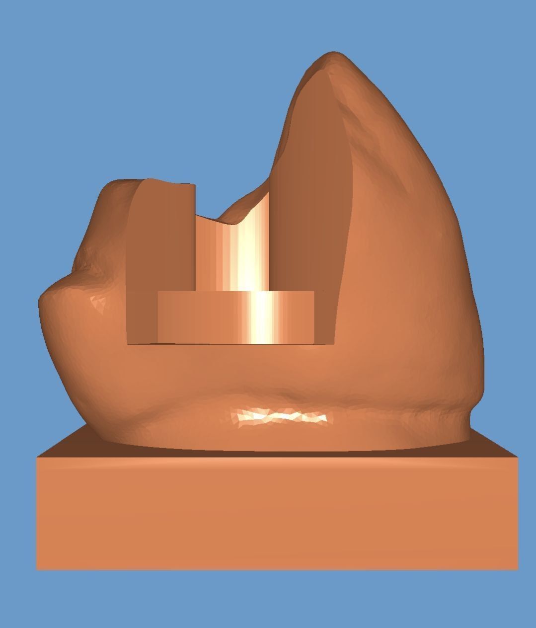Class ii Amalgam cavity preparation on upper molar 3D model 3D ...