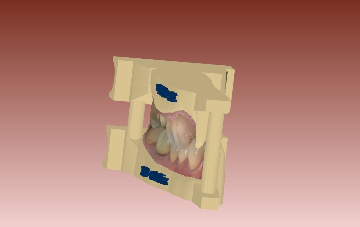 Digital Quadrant Model with Orbix WPins Articulator Interfaces 3D model ...