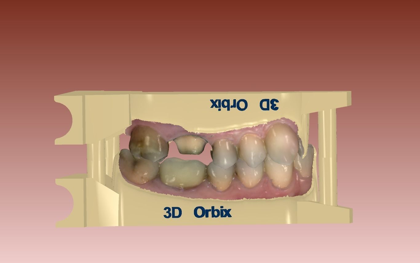 Digital Quadrant Model with Orbix WPins Articulator Interfaces 3D model ...