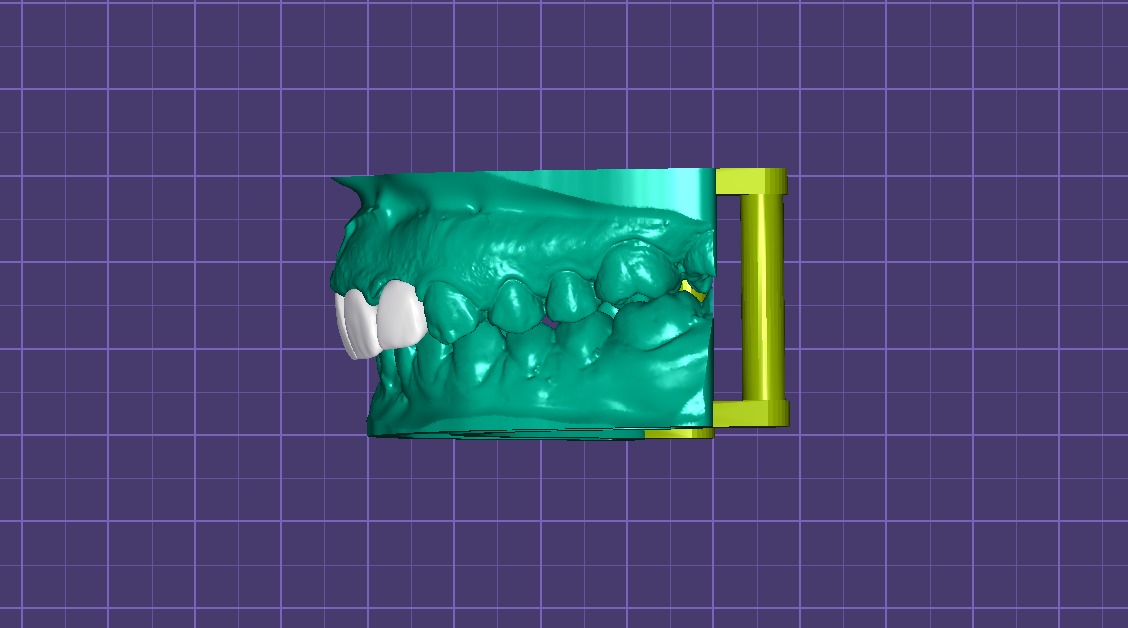 4-Unit Dental Bridge Design free 3D model 3D printable | CGTrader
