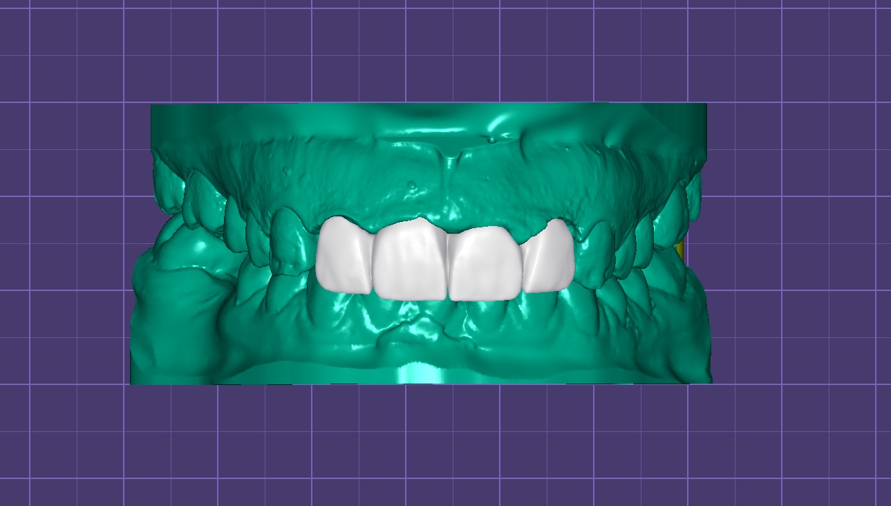 4-Unit Dental Bridge Design free 3D model 3D printable | CGTrader