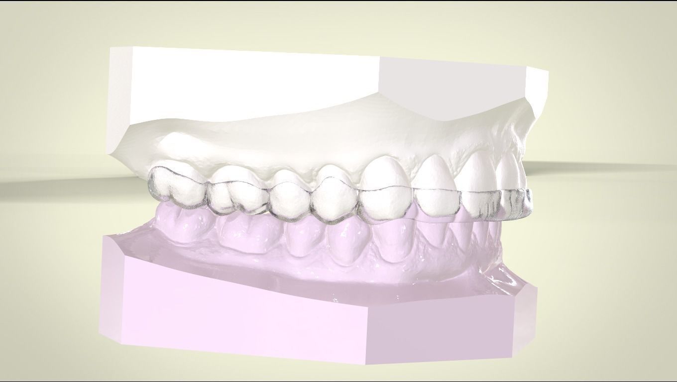 Digital Spear Deprogrammer Splint 3D model 3D printable | CGTrader