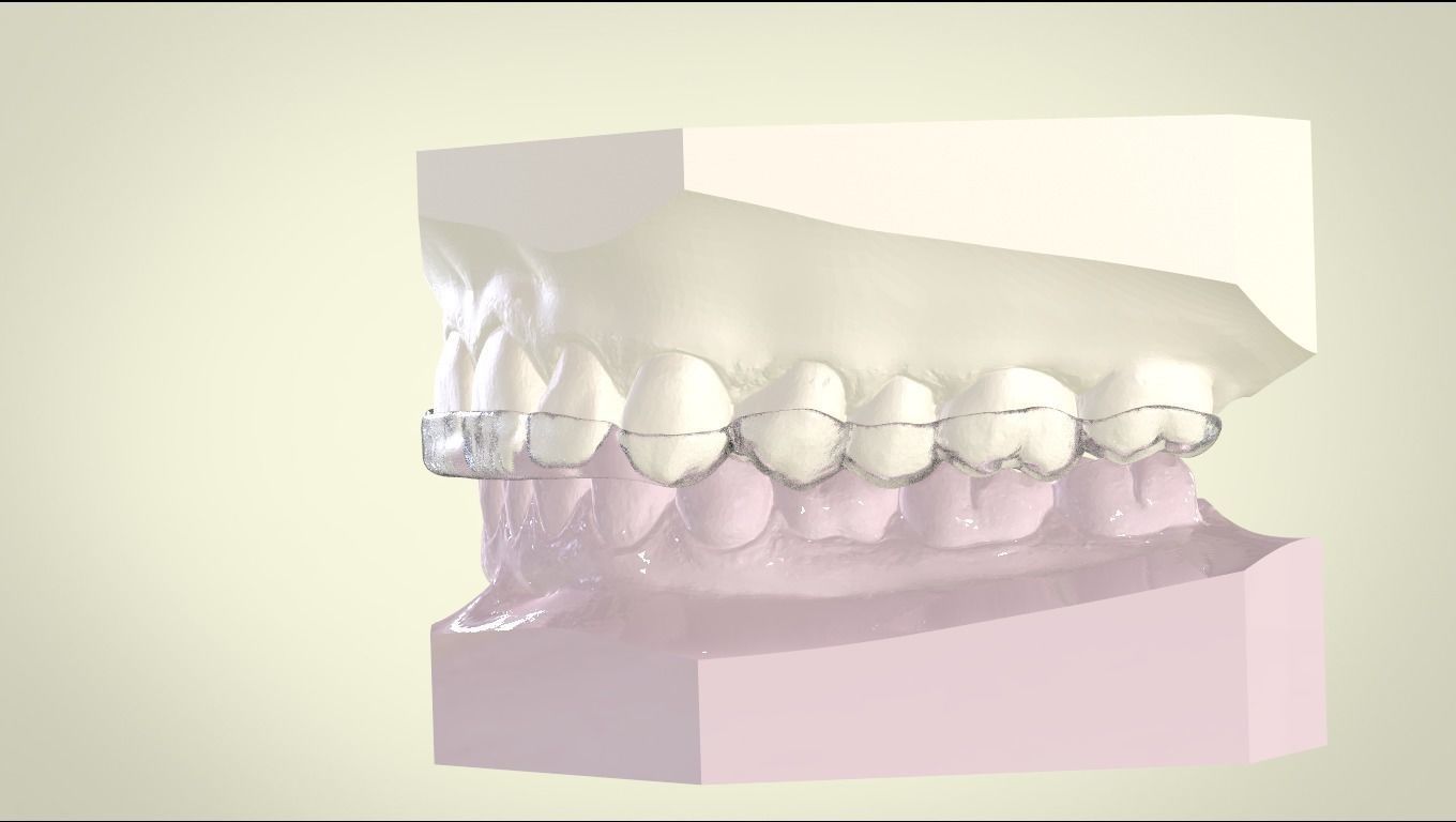 Digital Spear Deprogrammer Splint 3D model 3D printable | CGTrader