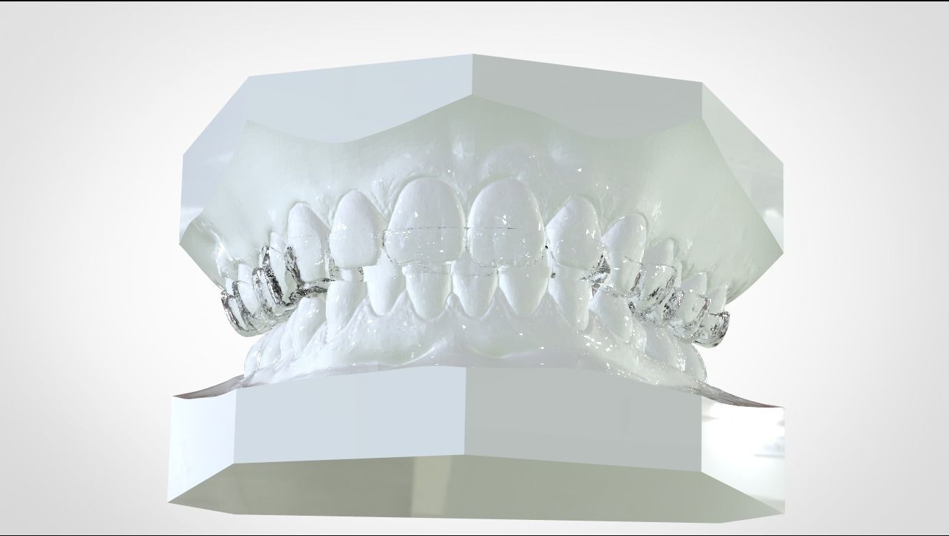 Digital Spear Deprogrammer Splint 3D model 3D printable | CGTrader