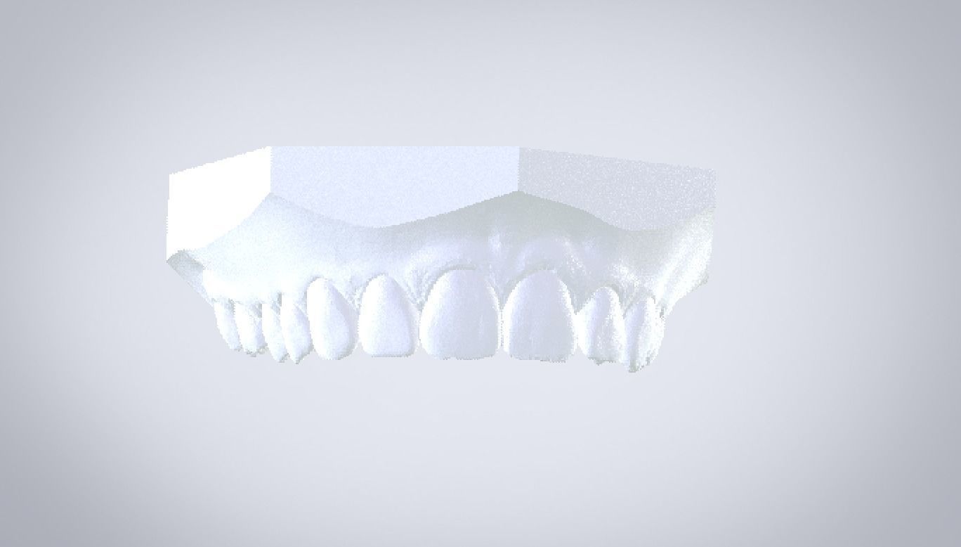 Digital Spear Deprogrammer Splint 3D model 3D printable | CGTrader