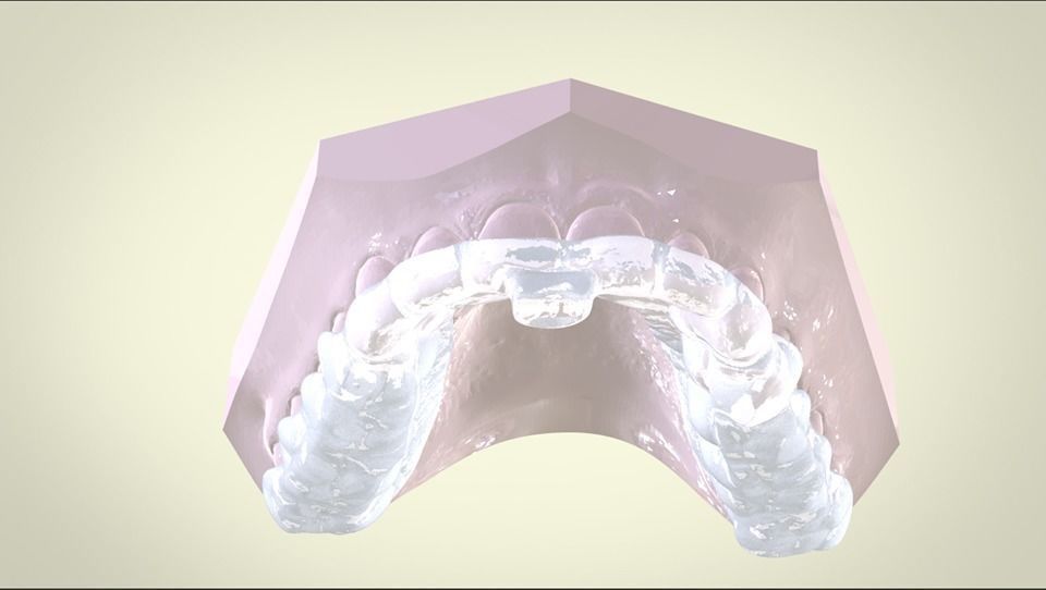 Digital Hard Nightguard Splint 3D model 3D printable | CGTrader