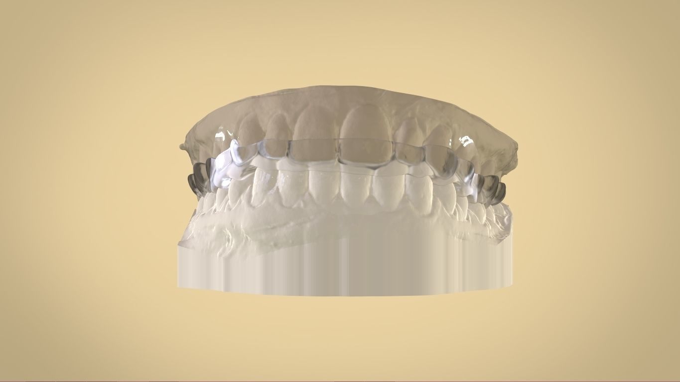Digital Dental Bite Splint 3D model 3D printable | CGTrader
