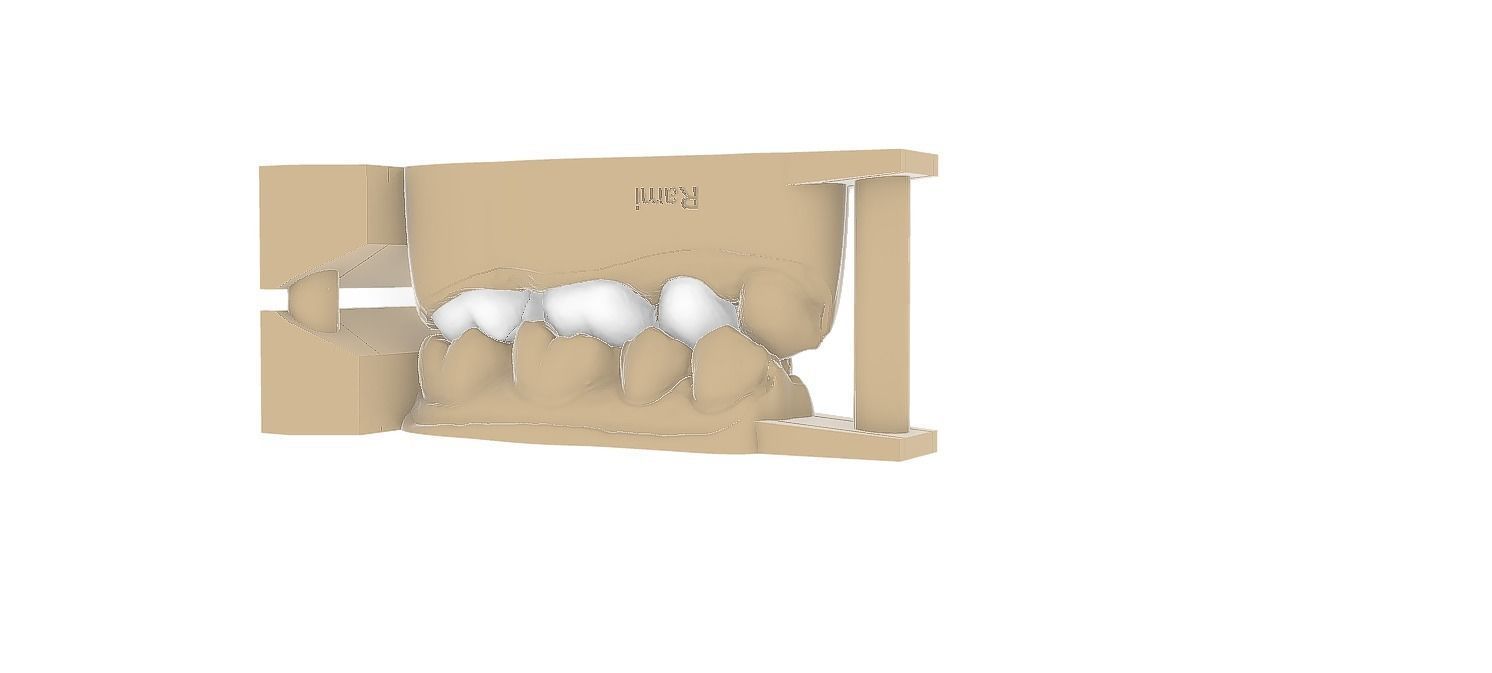 Digital Inlay Bridge Model 3D model 3D printable | CGTrader