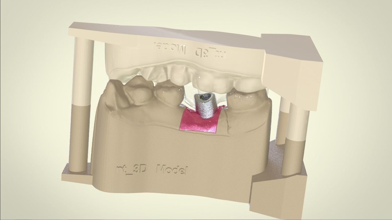 Digital Dental Implant Model with Positioning Guide 3D model 3D ...