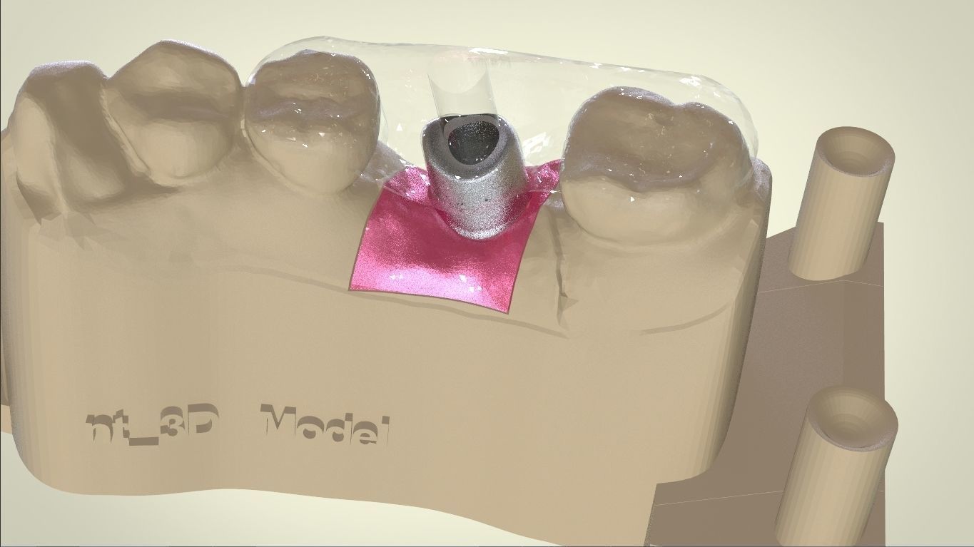 Digital Dental Implant Model with Positioning Guide 3D model 3D ...