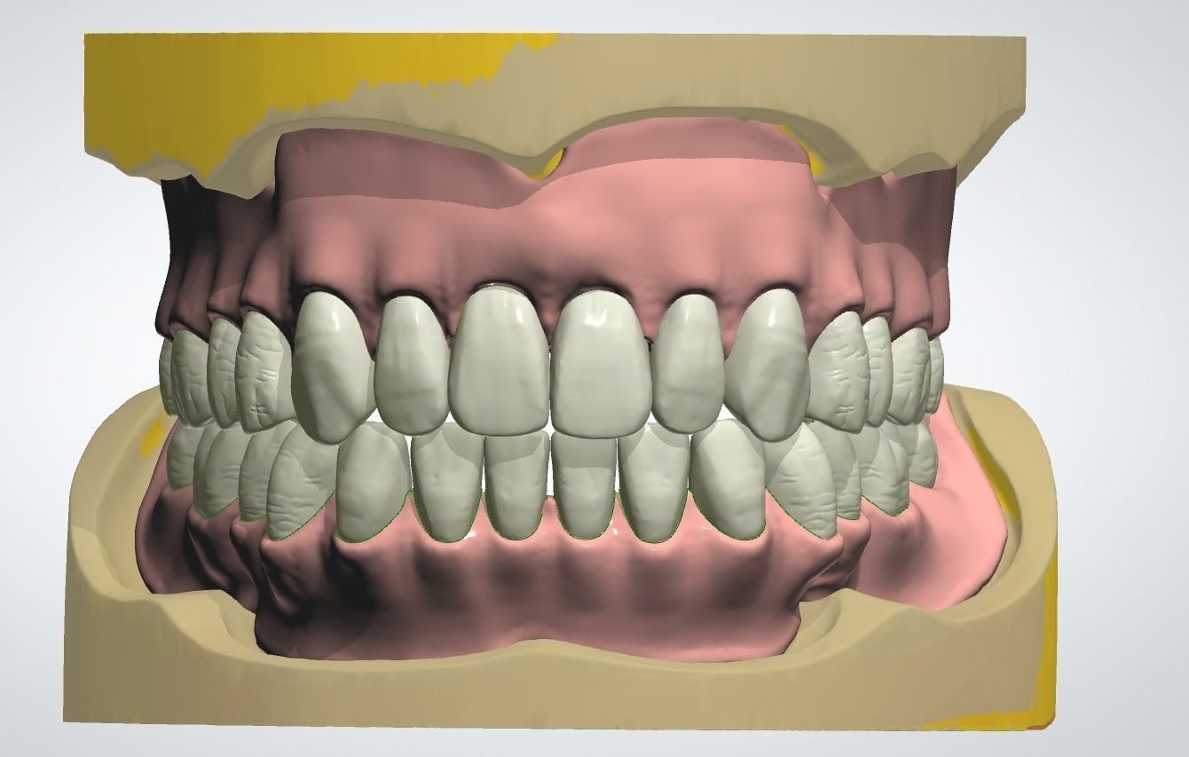 Digital full denture 3D model 3D printable | CGTrader