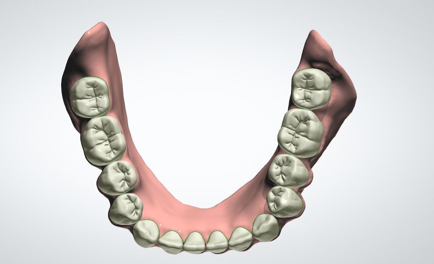 Digital full denture 3D model 3D printable | CGTrader