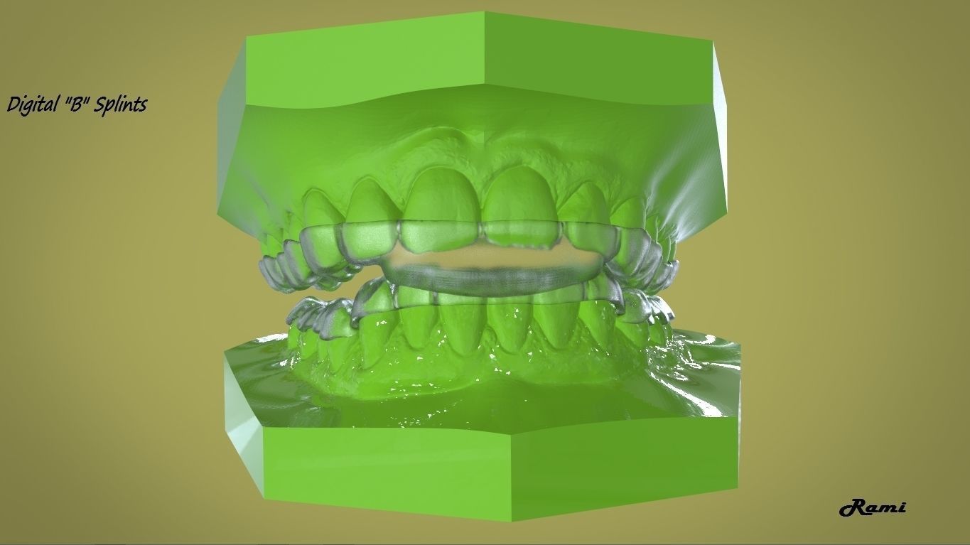Digital Dental B Splints 3D model 3D printable | CGTrader