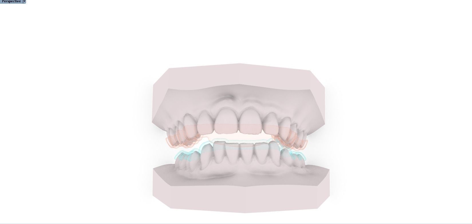 Digital Dental B Splints 3D model 3D printable | CGTrader