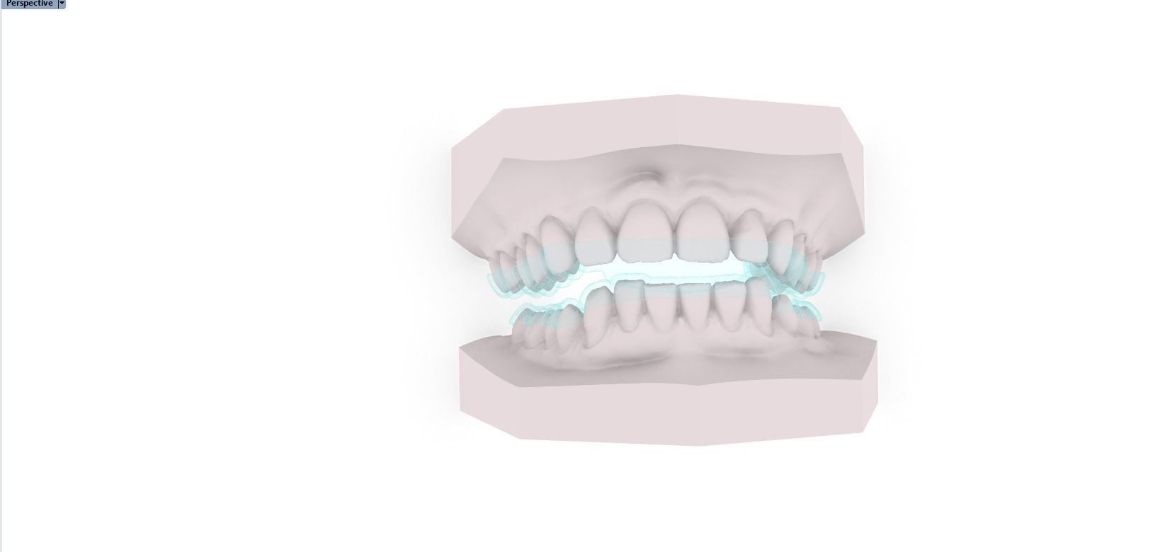 Digital Dental B Splints 3D model 3D printable | CGTrader