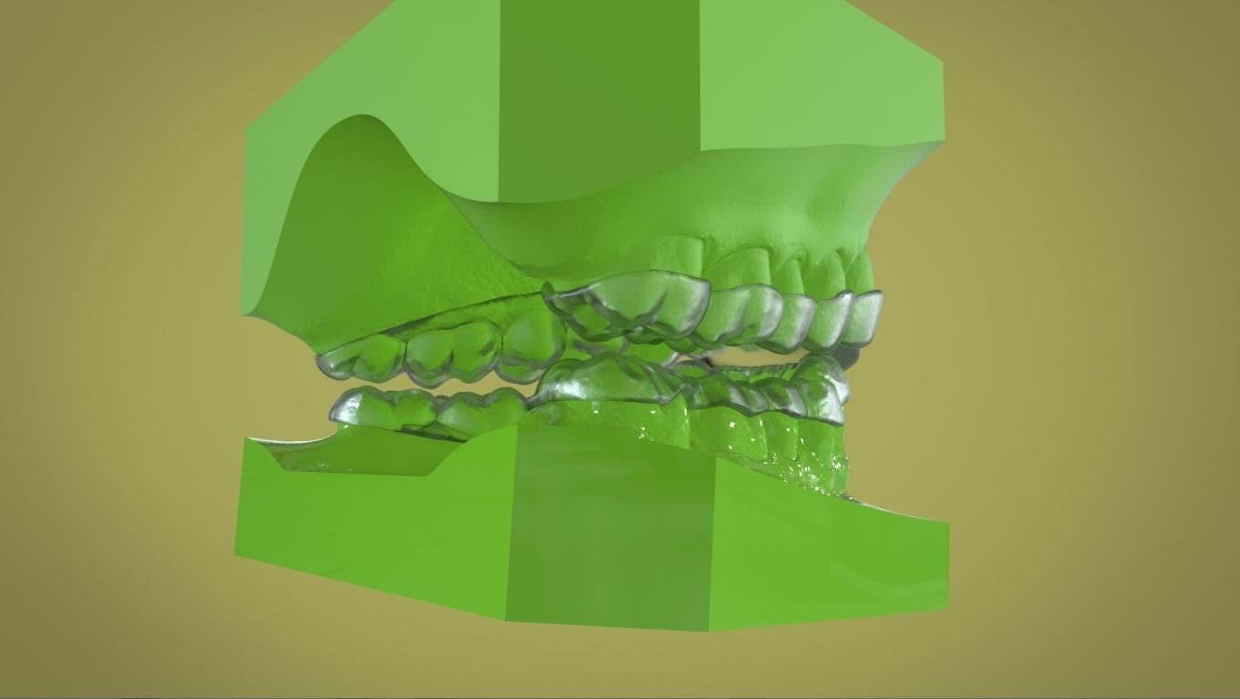 Digital Dental B Splints 3D model 3D printable | CGTrader