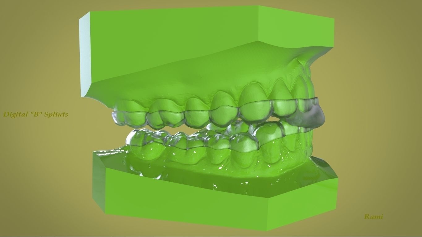 Digital Dental B Splints 3D model 3D printable | CGTrader